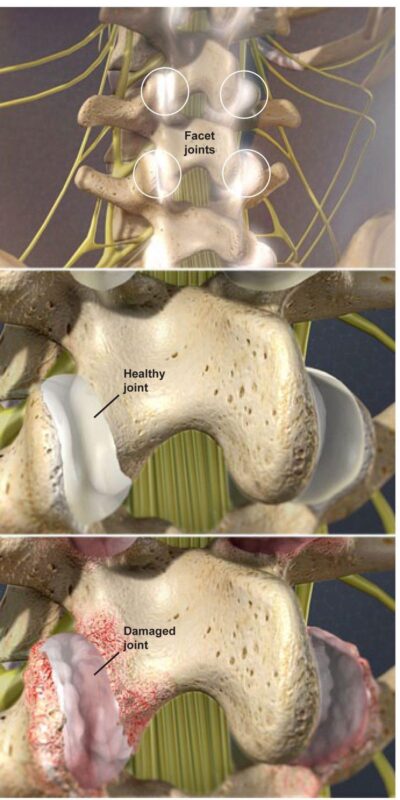 Facet Joint Syndrome Treatment Plano, TX | Advanced Spine Center