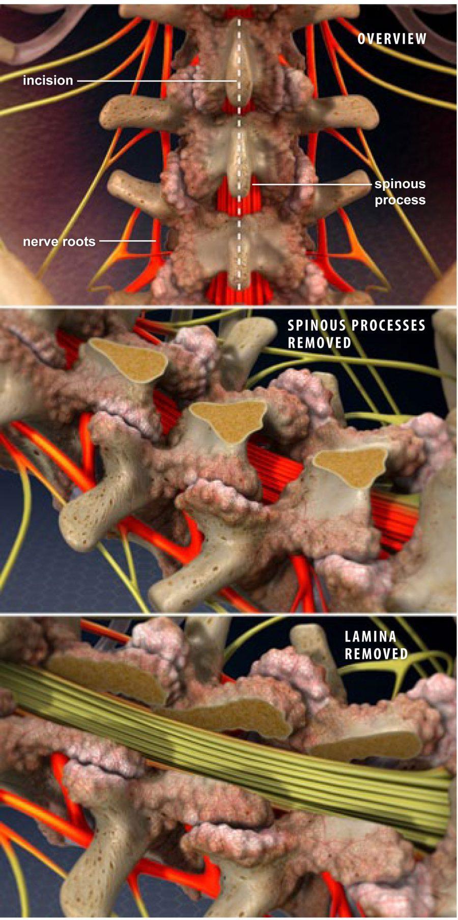 Laminectomy Surgery Specialist in Plano | Advanced Spine Center