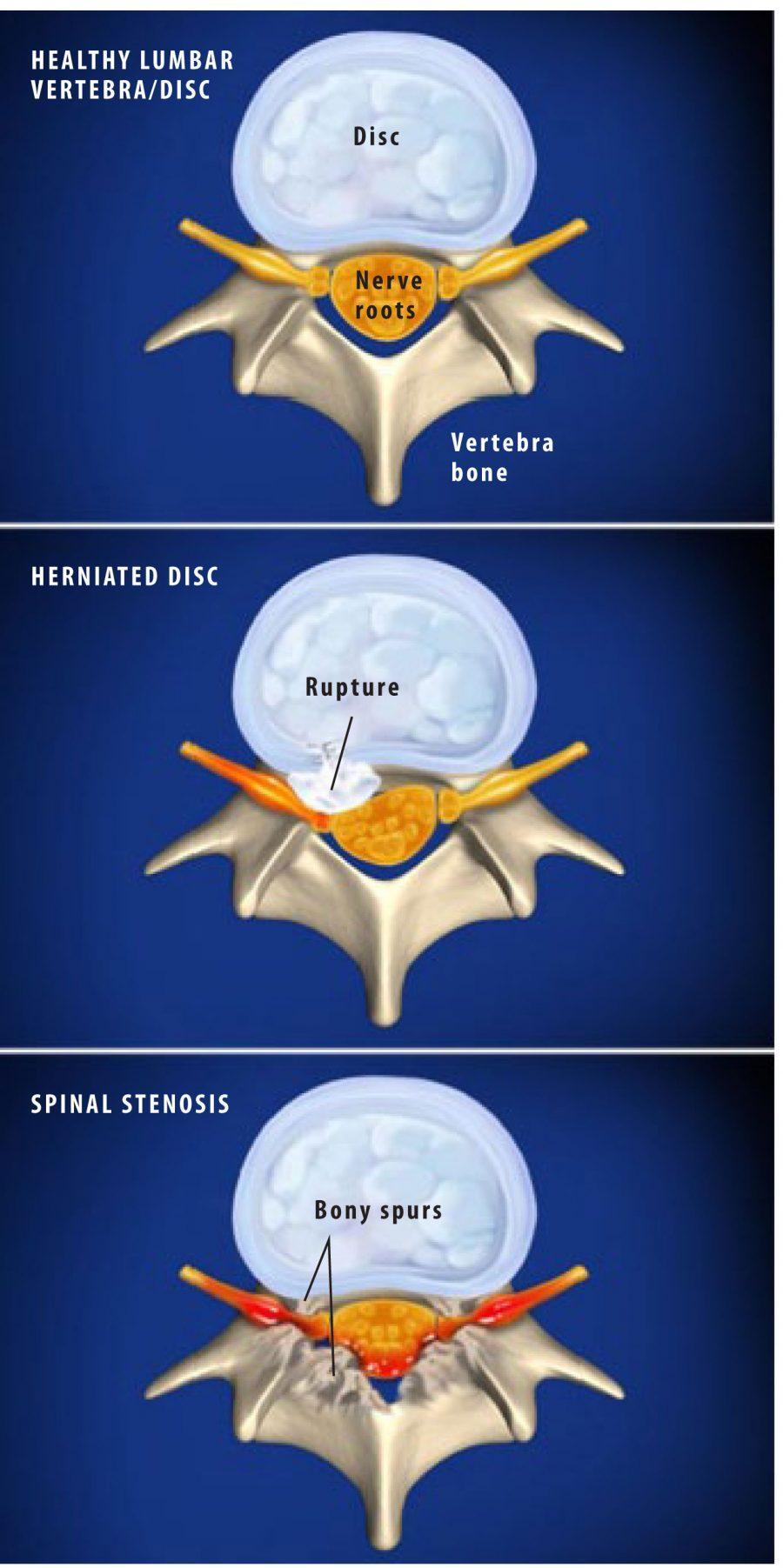 Lumbar Radiculopathy Treatment in Plano | Advanced Spine Center
