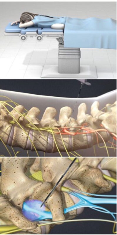 Lumbar Transforaminal Epidural Steroid Injection Plano, TX