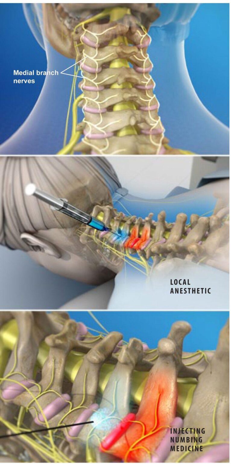 Cervical Medial Branch Block Plano, TX | Advanced Spine Center