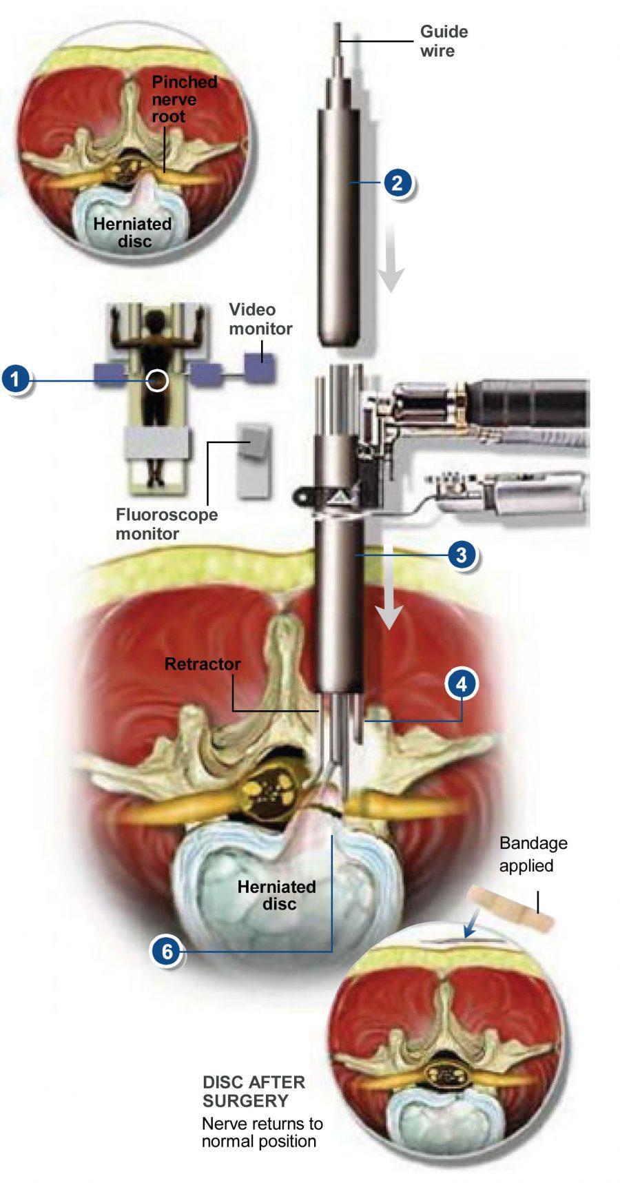 Micro Endoscopic Discectomy Plano, TX | Advanced Spine Center