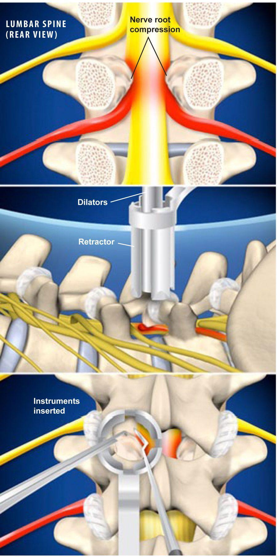 Minimally-Invasive Lumbar Microdecompression Plano, TX | ASC