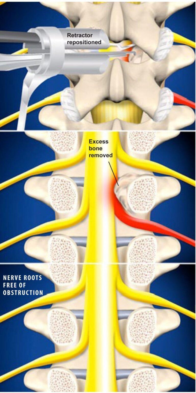 Minimally-Invasive Lumbar Microdecompression Plano, TX | ASC