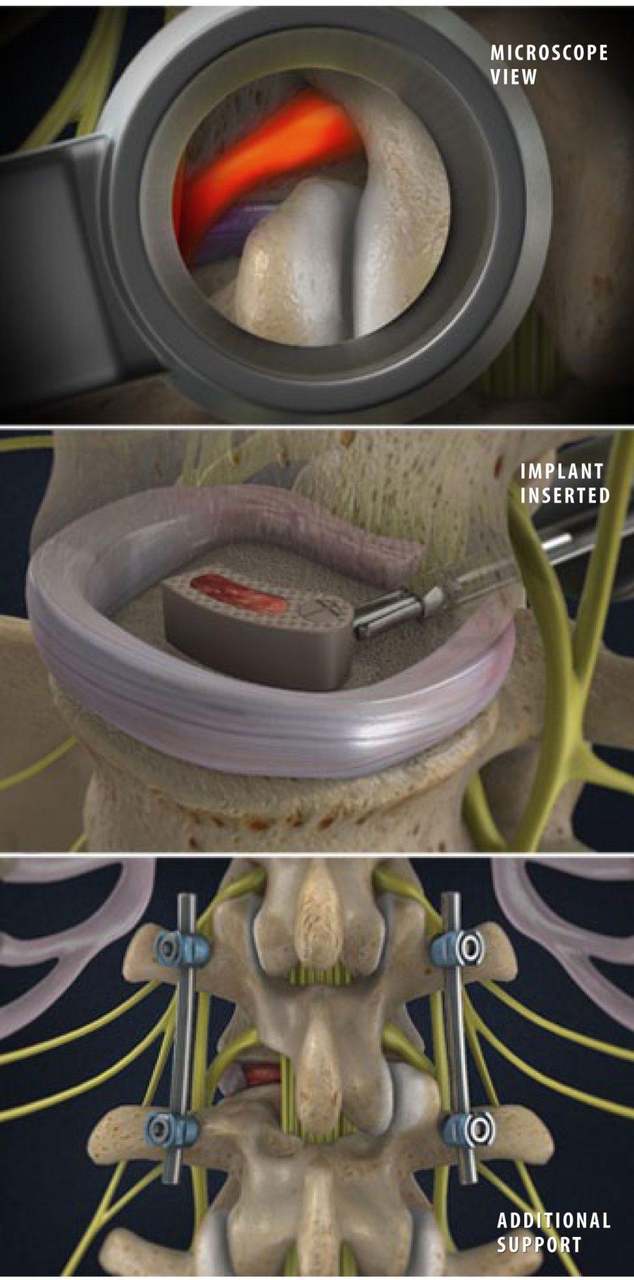 Minimally-Invasive TLIF Transforaminal Lumbar Interbody Fusion | Plano, TX