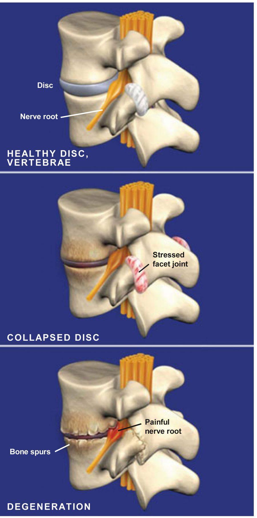 Spondylosis Treatment Plano, TX | Advanced Spine Center