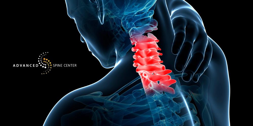 Cervical Fusion Surgery Plano, Texas | Advanced Spine Center