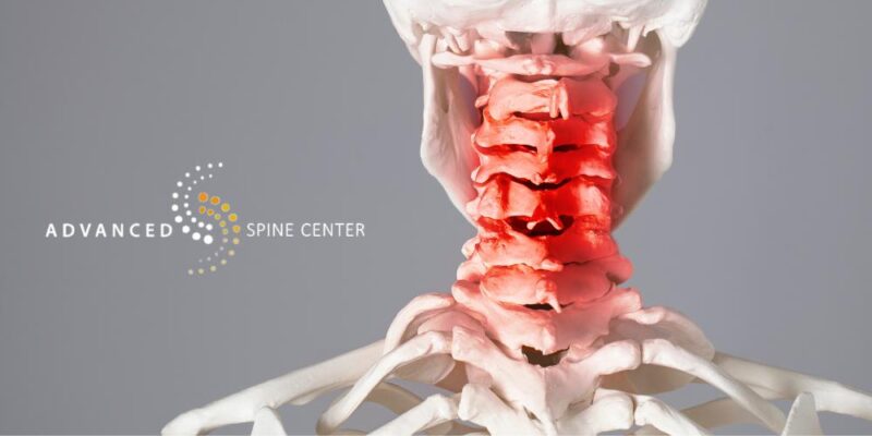 Cervical Fusion Surgery Frisco, TX | Advanced Spine Center