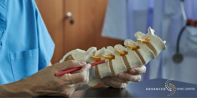Lumbar Fusion Surgery Frisco, TX | The Advanced Spine Center