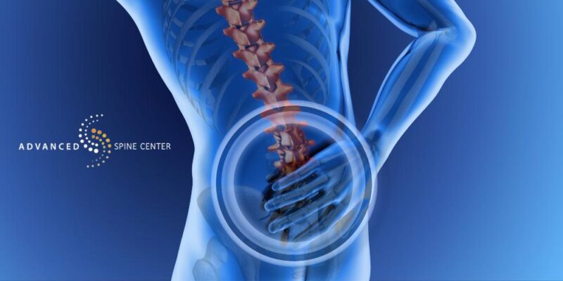 Lumbar Revision Surgery Frisco, TX | Advanced Spine Center