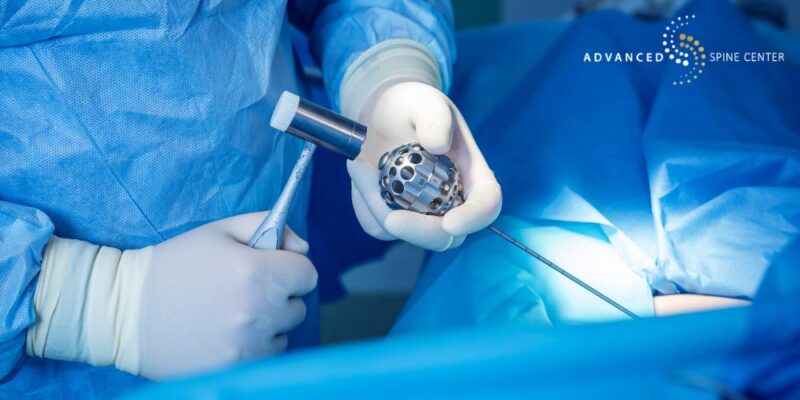 Lumbar Microdiscectomy Frisco, TX | Advanced Spine Center