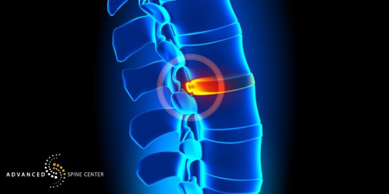Lumbar Minimally Invasive Spine Surgery Frisco, TX | Dr. Courtney