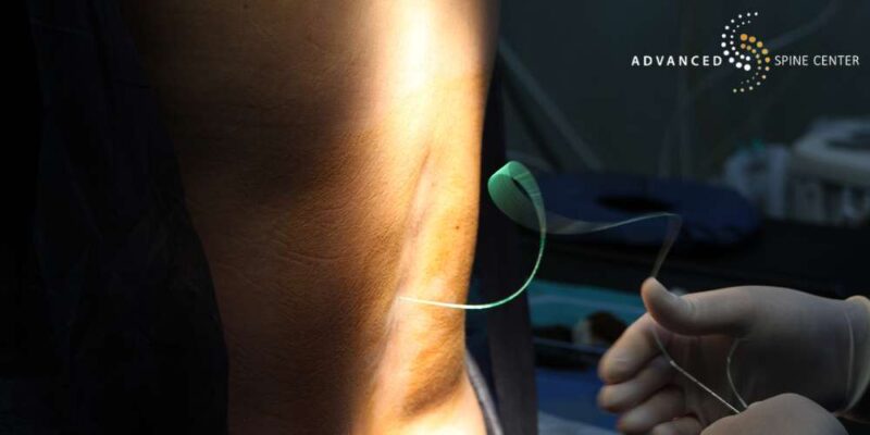 Lumbar Epidural Steroid Injection Without Contrast | Plano | Dr. Courtney