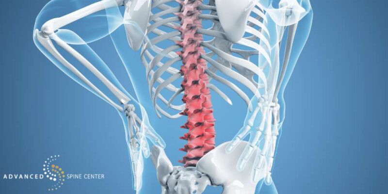 Transforaminal Lumbar Interbody Fusion (TLIF) Surgery in Plano