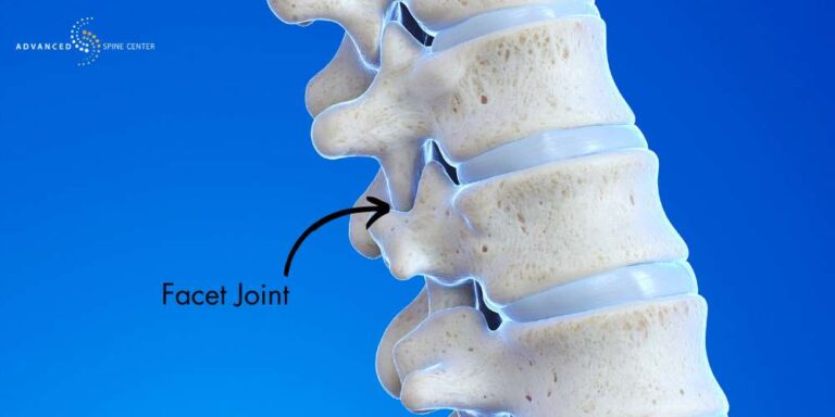 Facet Hypertrophy Treatment Plano, TX | Advanced Spine Center