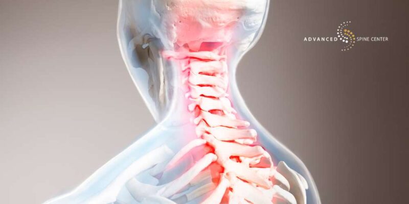 Anterolisthesis Treatment in Plano, TX | Advanced Spine Center