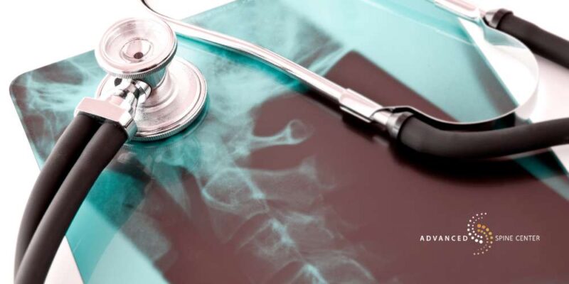 Bertolotti Syndrome Treatment | Advanced Spine Center