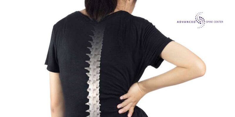 Flatback Syndrome Treatment Plano, TX | Advanced Spine Center