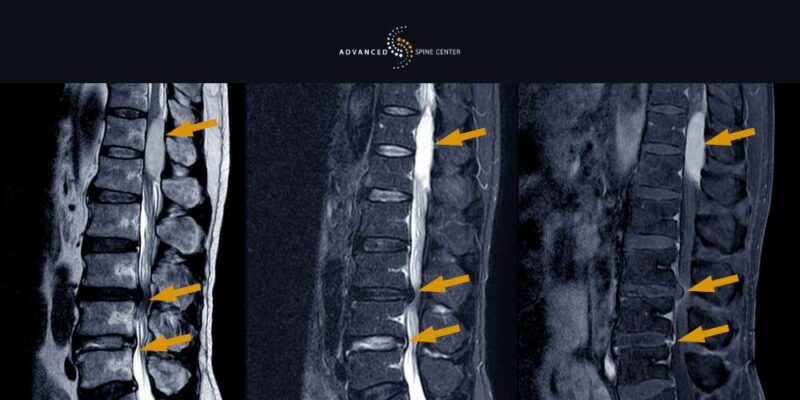 Foraminal Stenosis Treatment | Advanced Spine Center
