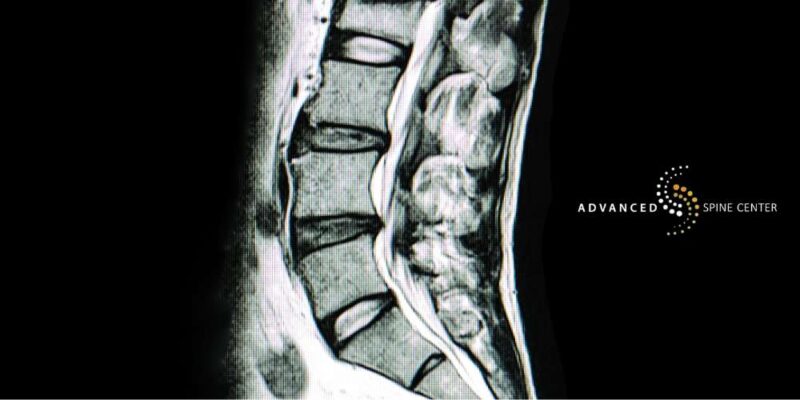 Can Kyphosis Be Reversed? | Advanced Spine Center | Plano, TX