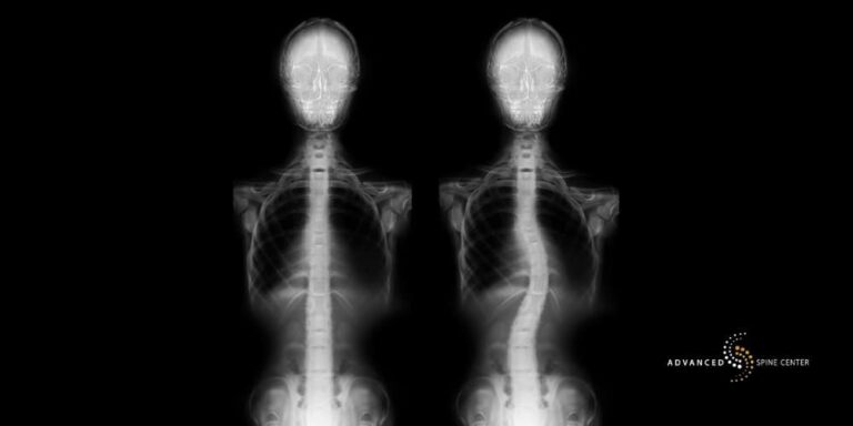 Scoliosis Treatment in Plano, TX | Advanced Spine Center