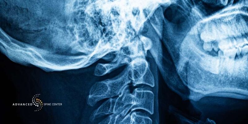 Uncovertebral Joint Hypertrophy Treatment in Plano, TX