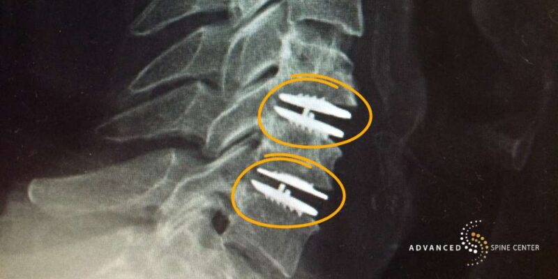 Artificial Disc Replacement Surgery | Advanced Spine Center