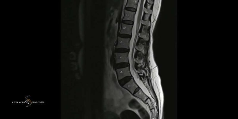 Cauda Equina Syndrome Treatment in Plano, TX