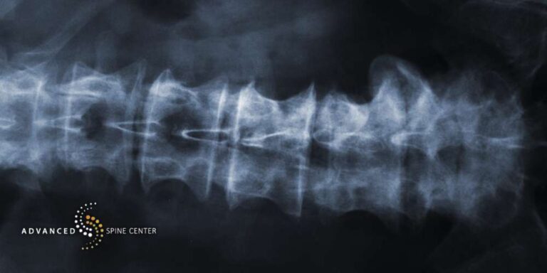 Lumbar Disc Replacement in Plano, TX | Advanced Spine Center