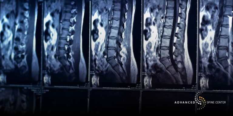 Lumbar Disc Replacement in Plano, TX | Advanced Spine Center